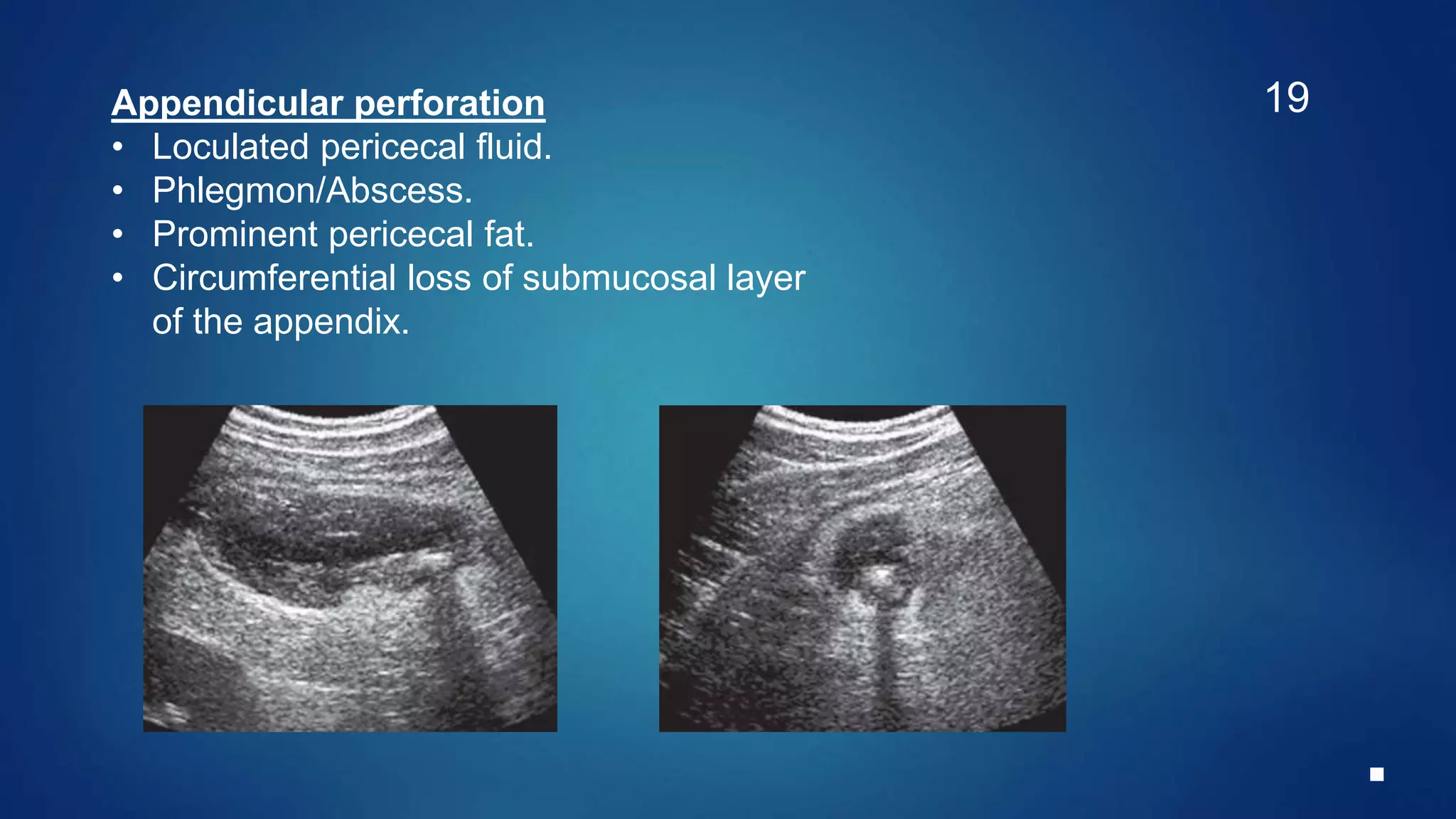 Ultrasonography in Acute Abdomen | PPTX