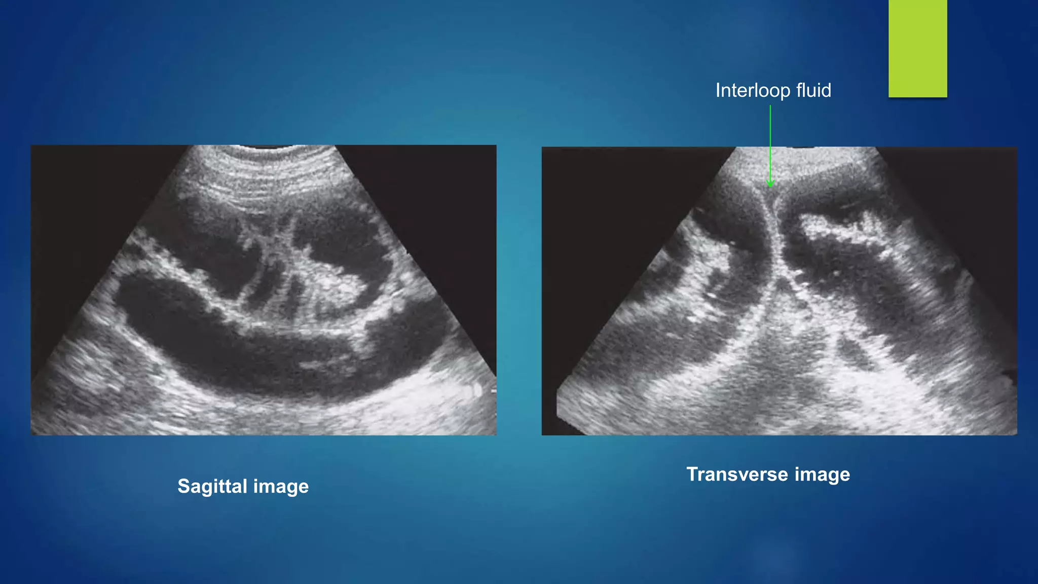 Ultrasonography in Acute Abdomen | PPTX
