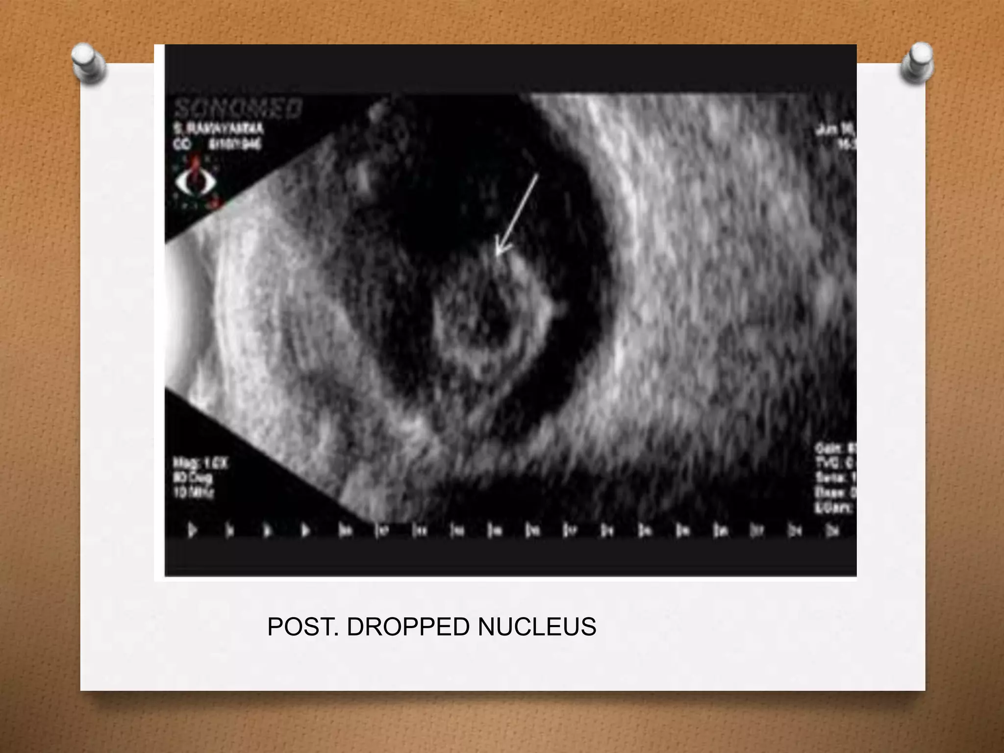 Ultrasonography of eye | PPTX