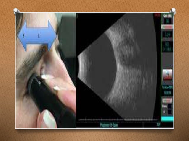 Ultrasonography of eye | PPTX