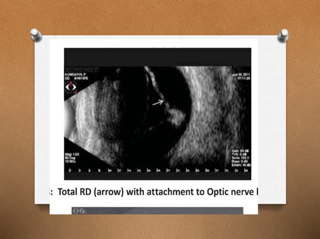 Ultrasonography of eye | PPTX