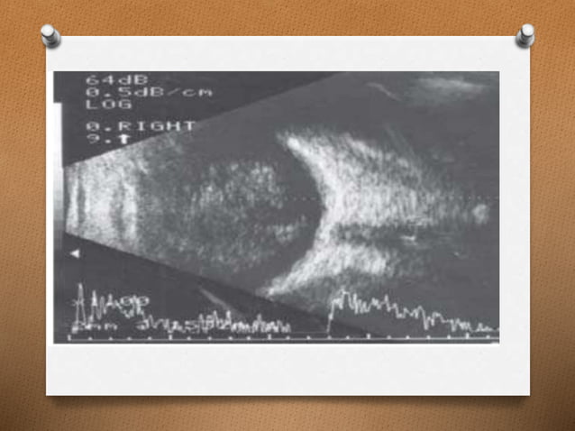 Ultrasonography of eye | PPTX