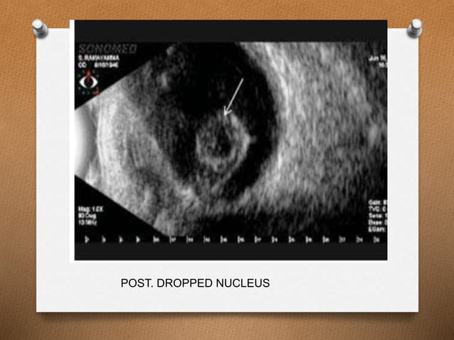 Ultrasonography of eye | PPT