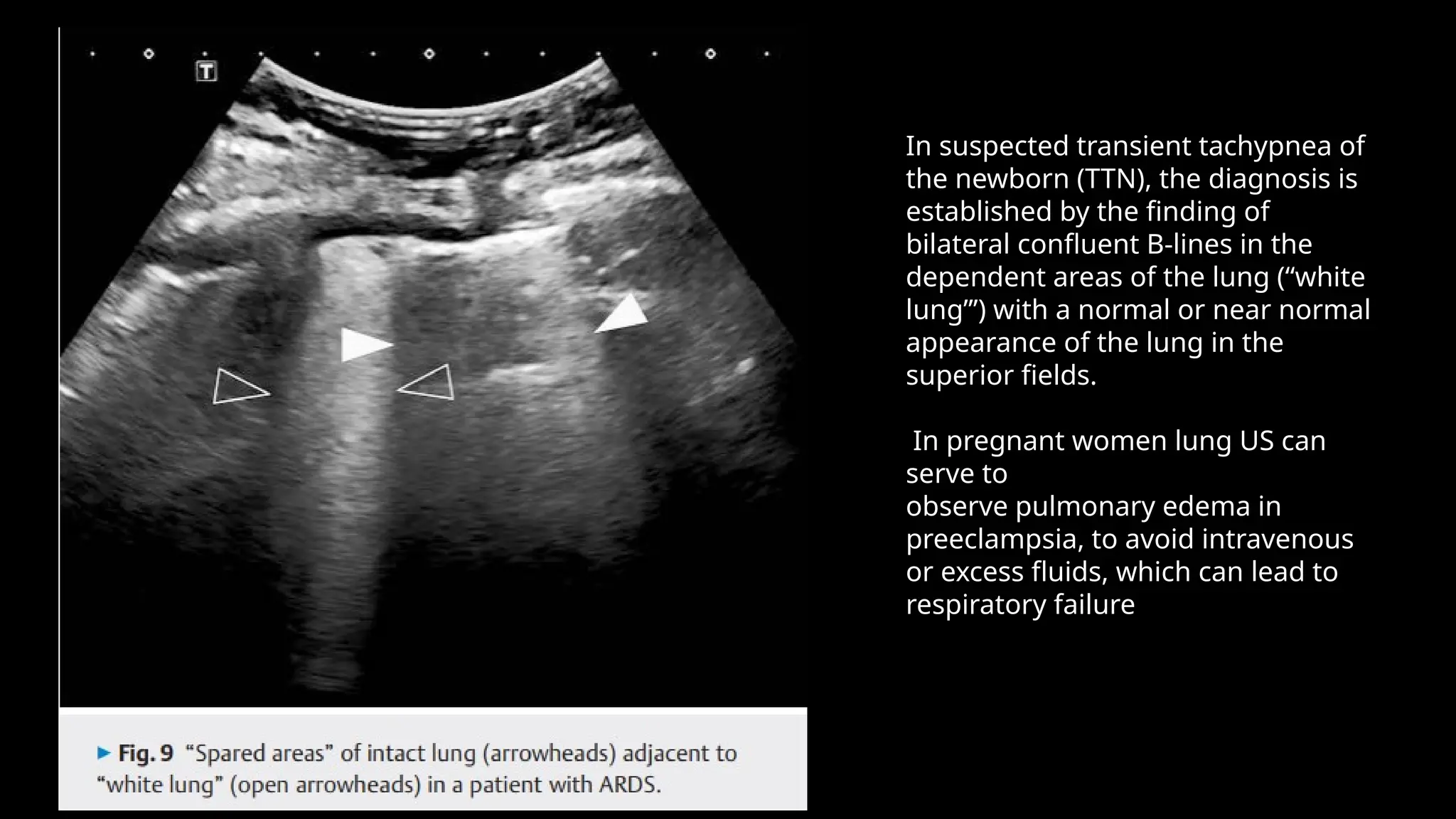 Ultrasonographic imaging of the Lung.pptx