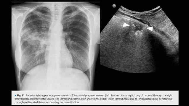 Ultrasonographic imaging of the Lung.pptx