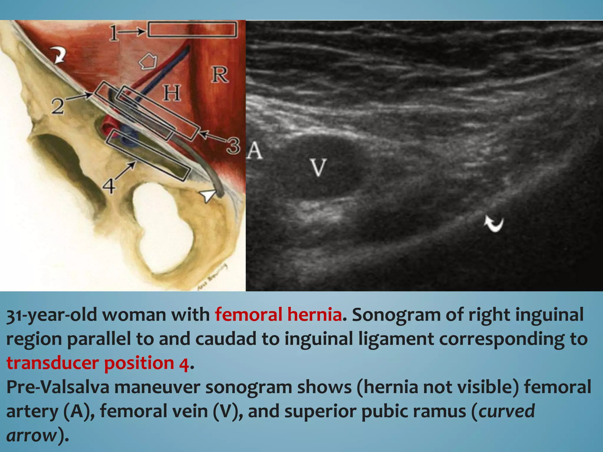 Inguinal And Femoral Hernia Ultrasound