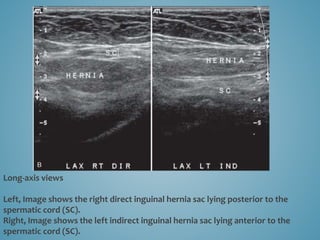 Ultrasoud hernia | PPTX