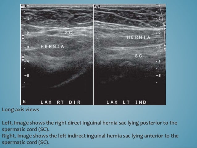 Ultrasoud hernia