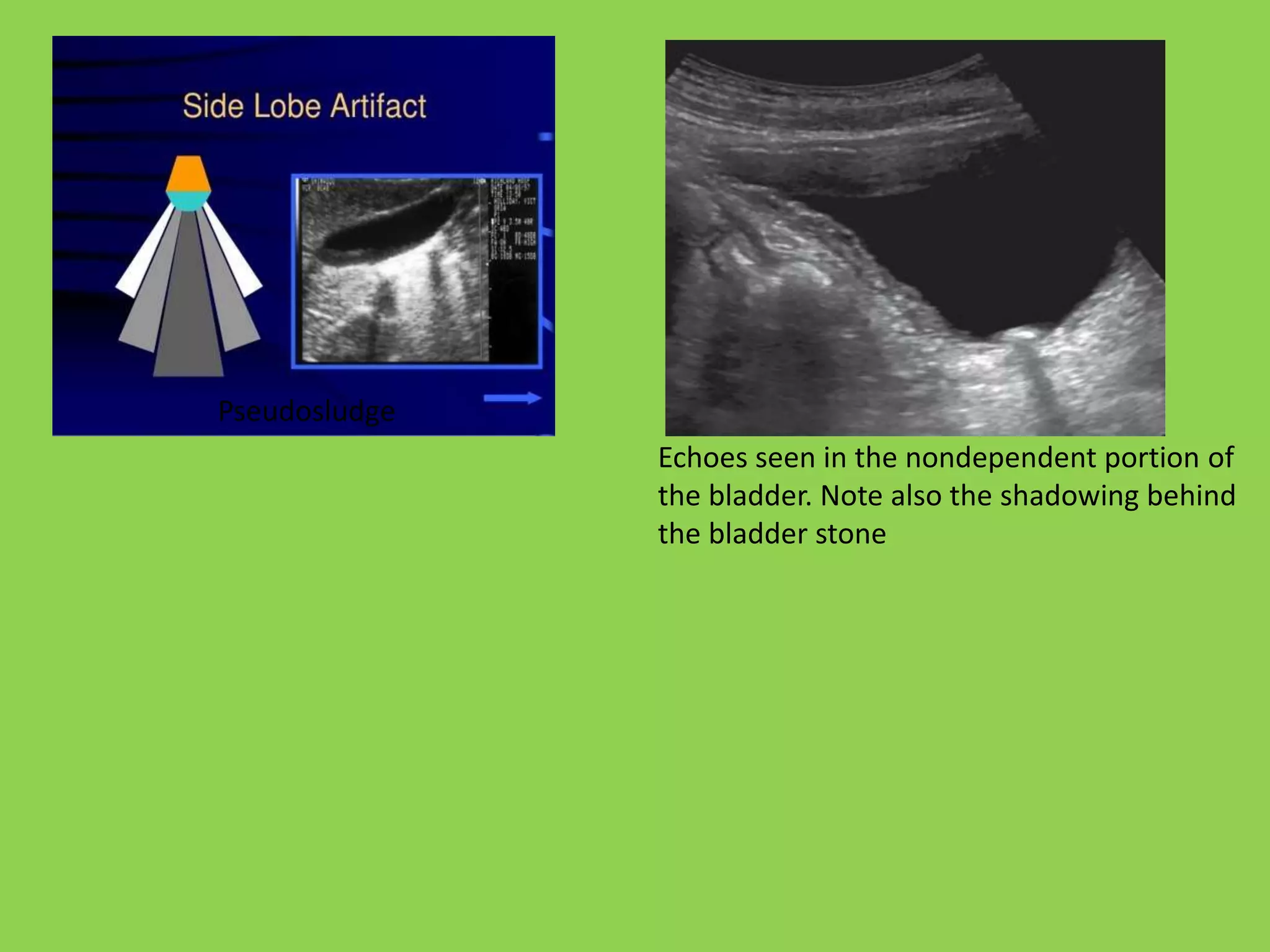 ULTRASOUND - ARTIFACTS.pptx
