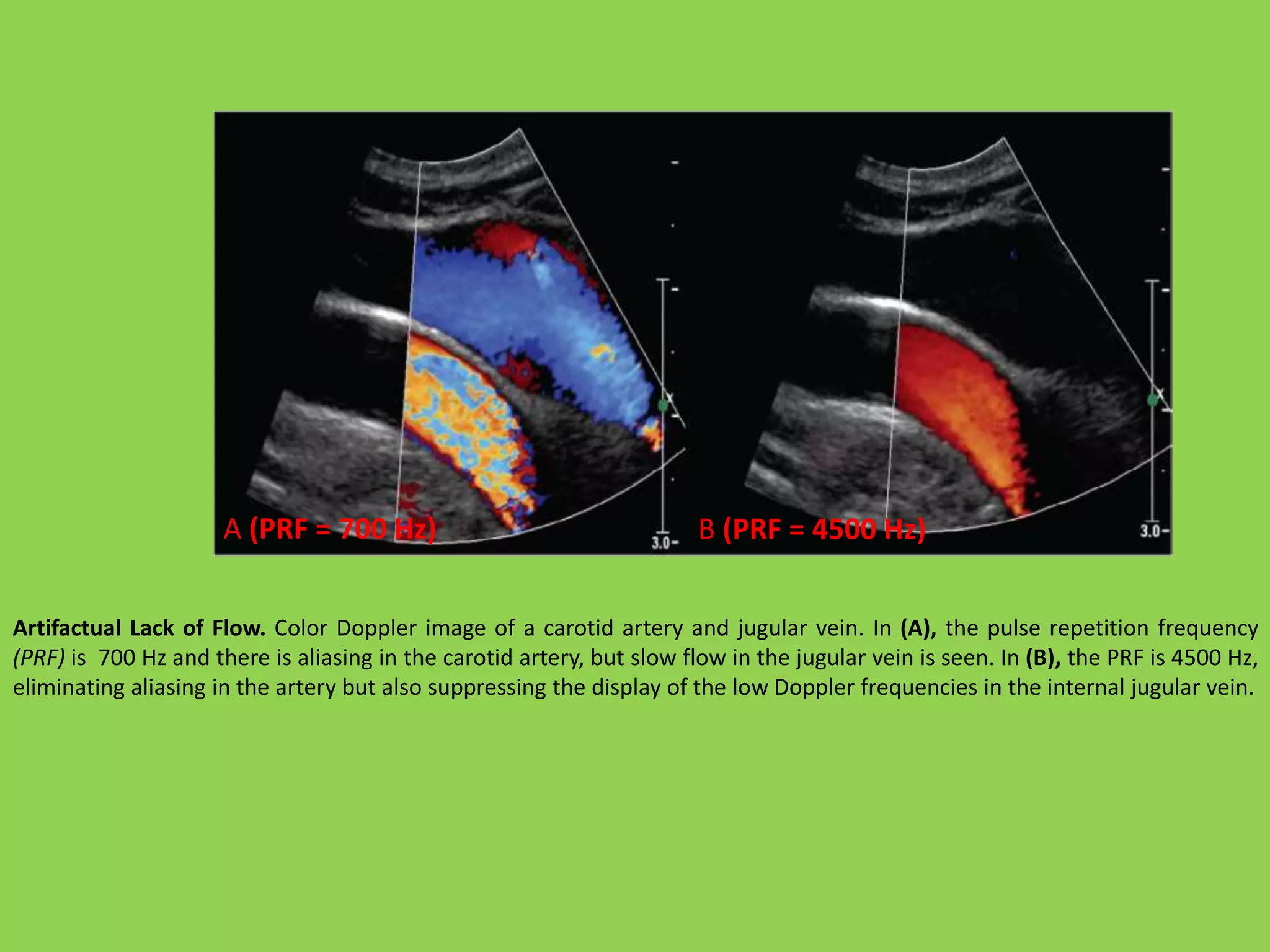 ULTRASOUND - ARTIFACTS.pptx