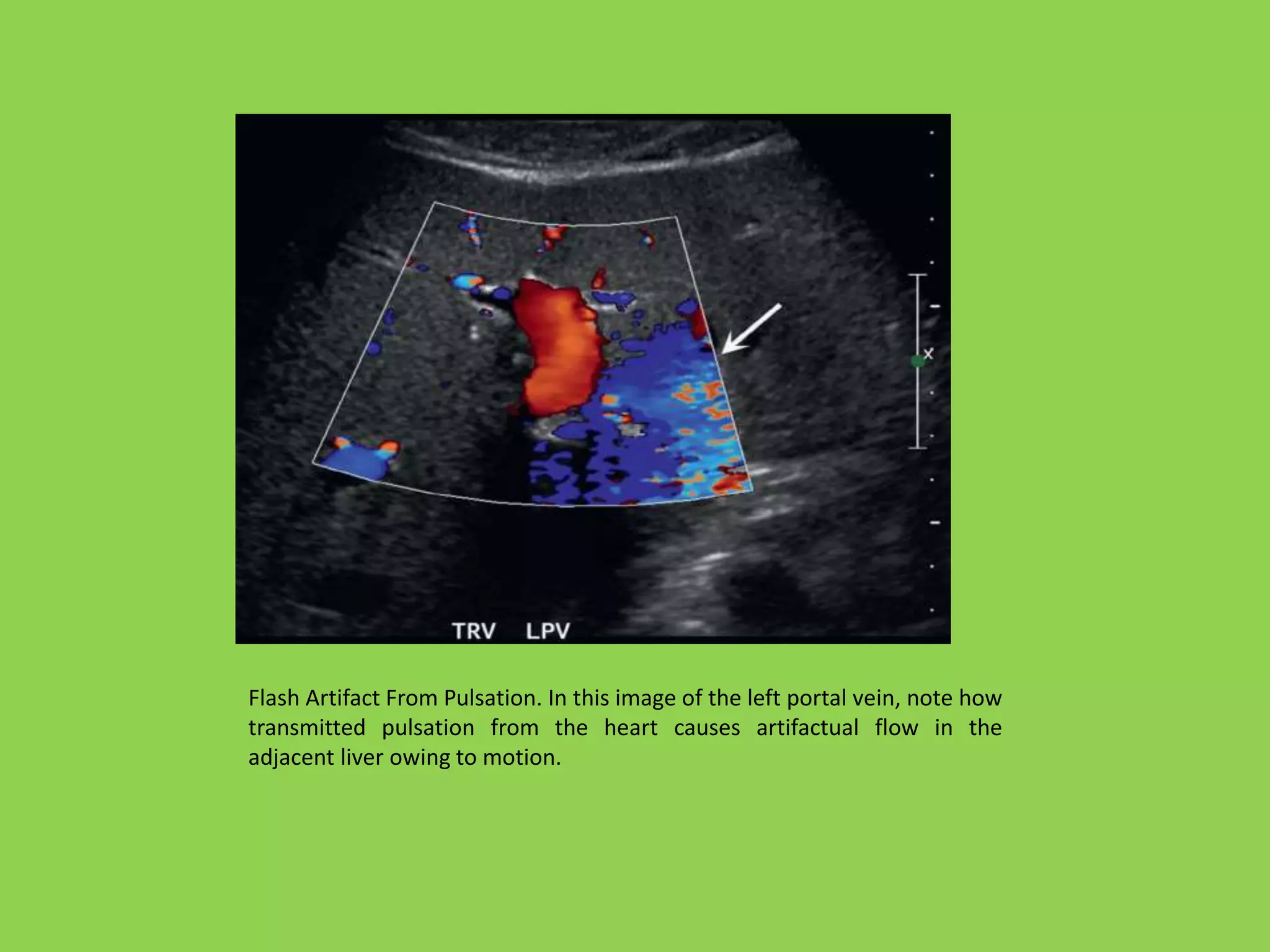 ULTRASOUND - ARTIFACTS.pptx