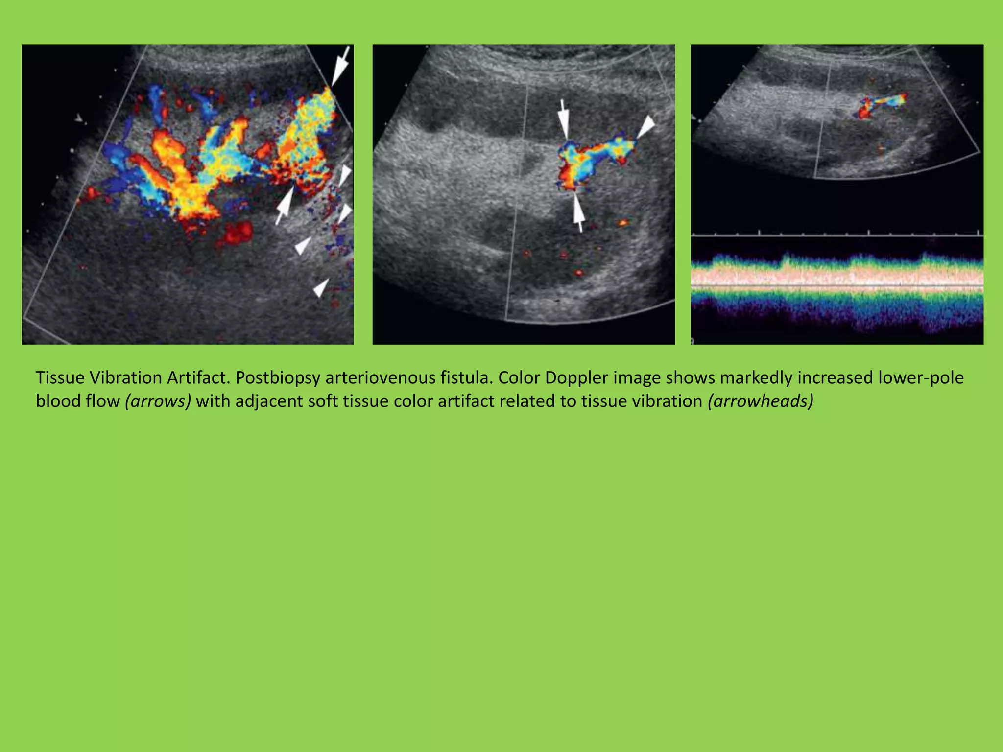 ULTRASOUND - ARTIFACTS.pptx