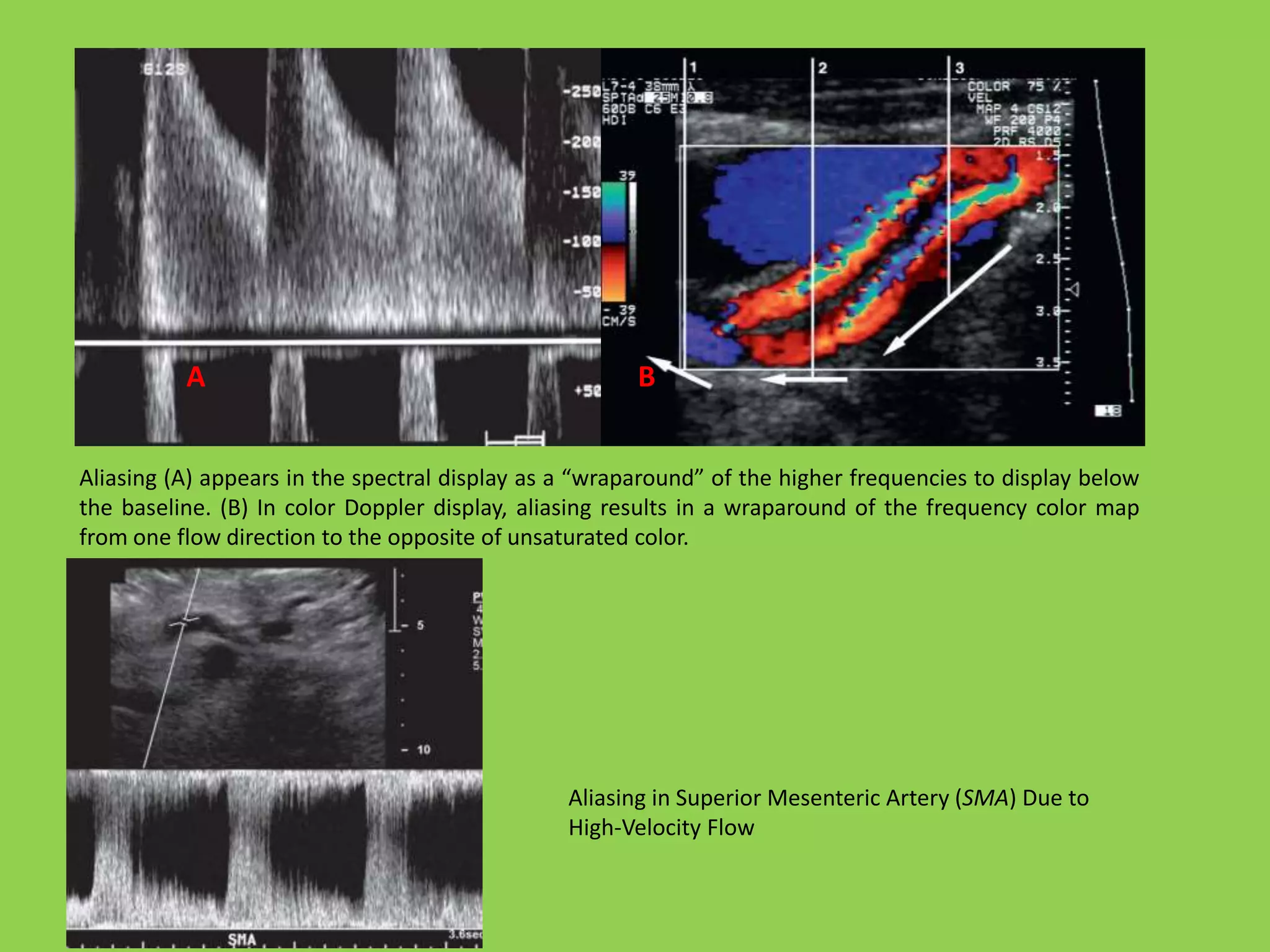 ULTRASOUND - ARTIFACTS.pptx