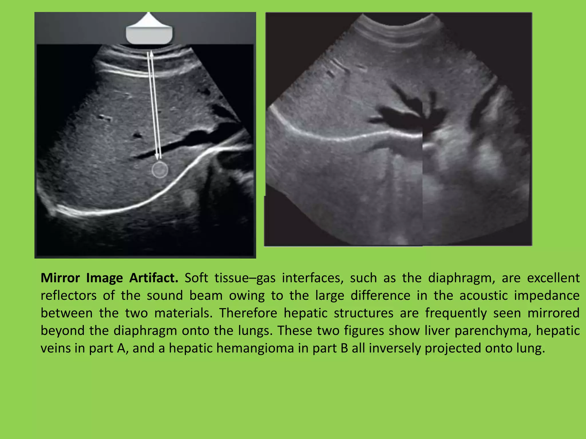 ULTRASOUND - ARTIFACTS.pptx