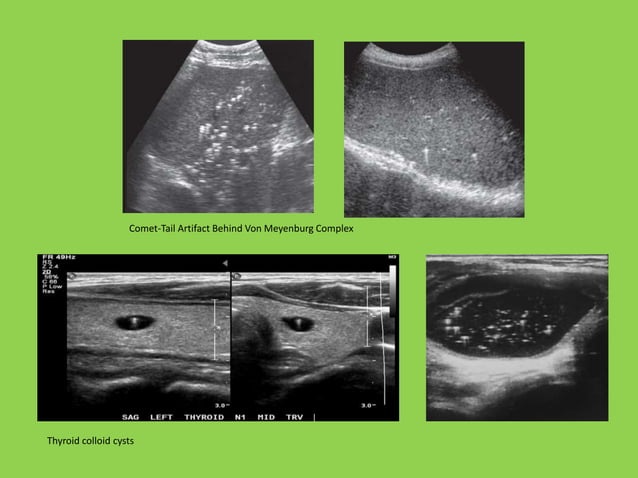 ULTRASOUND - ARTIFACTS.pptx | Medical Health