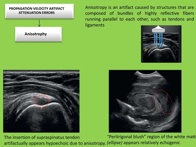 ULTRASOUND - ARTIFACTS.pptx | Medical Health
