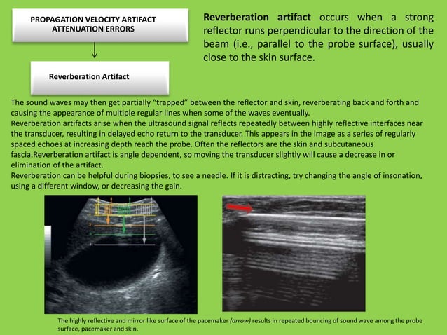 ULTRASOUND - ARTIFACTS.pptx | Medical Health
