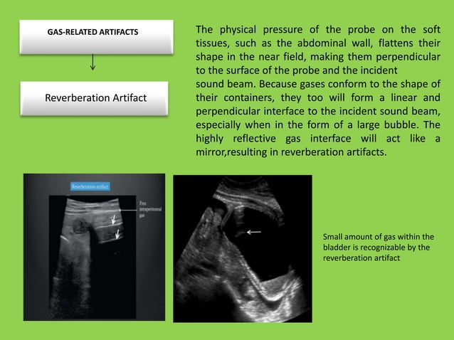 ULTRASOUND - ARTIFACTS.pptx | Medical Health