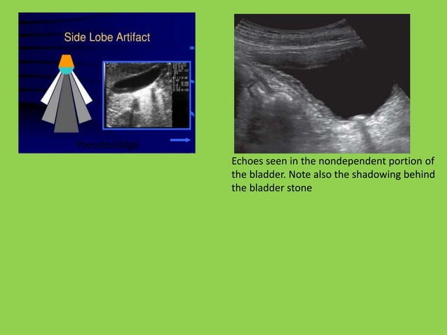ULTRASOUND - ARTIFACTS.pptx | Medical Health