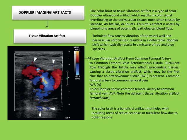 ULTRASOUND - ARTIFACTS.pptx | Medical Health