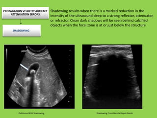 ULTRASOUND - ARTIFACTS.pptx