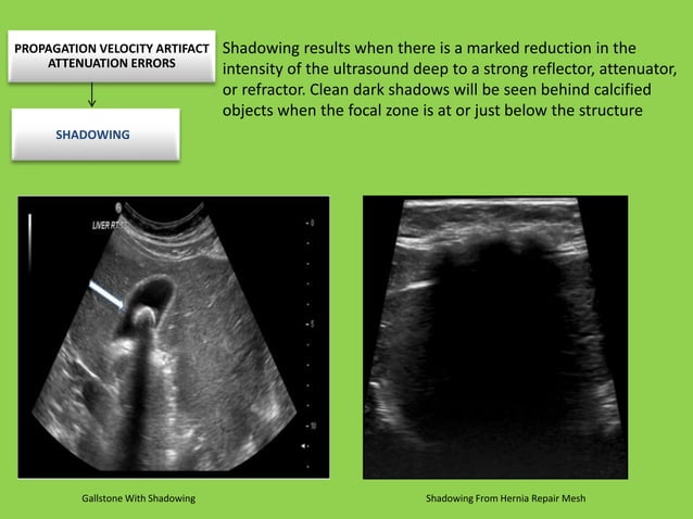 ULTRASOUND - ARTIFACTS.pptx | Medical Health