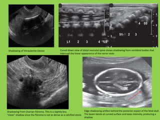 ULTRASOUND - ARTIFACTS.pptx
