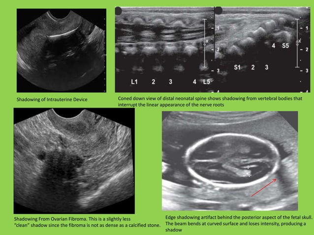 ULTRASOUND - ARTIFACTS.pptx | Medical Health