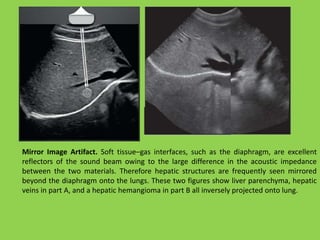 ULTRASOUND - ARTIFACTS.pptx