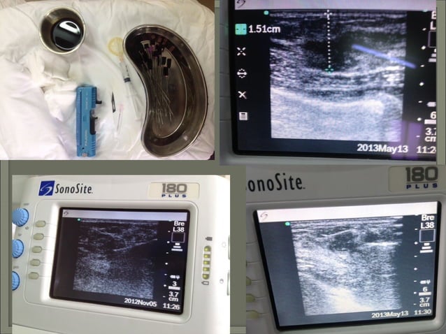 Ultrasound-Guided Breast Core Biopsy | PPT