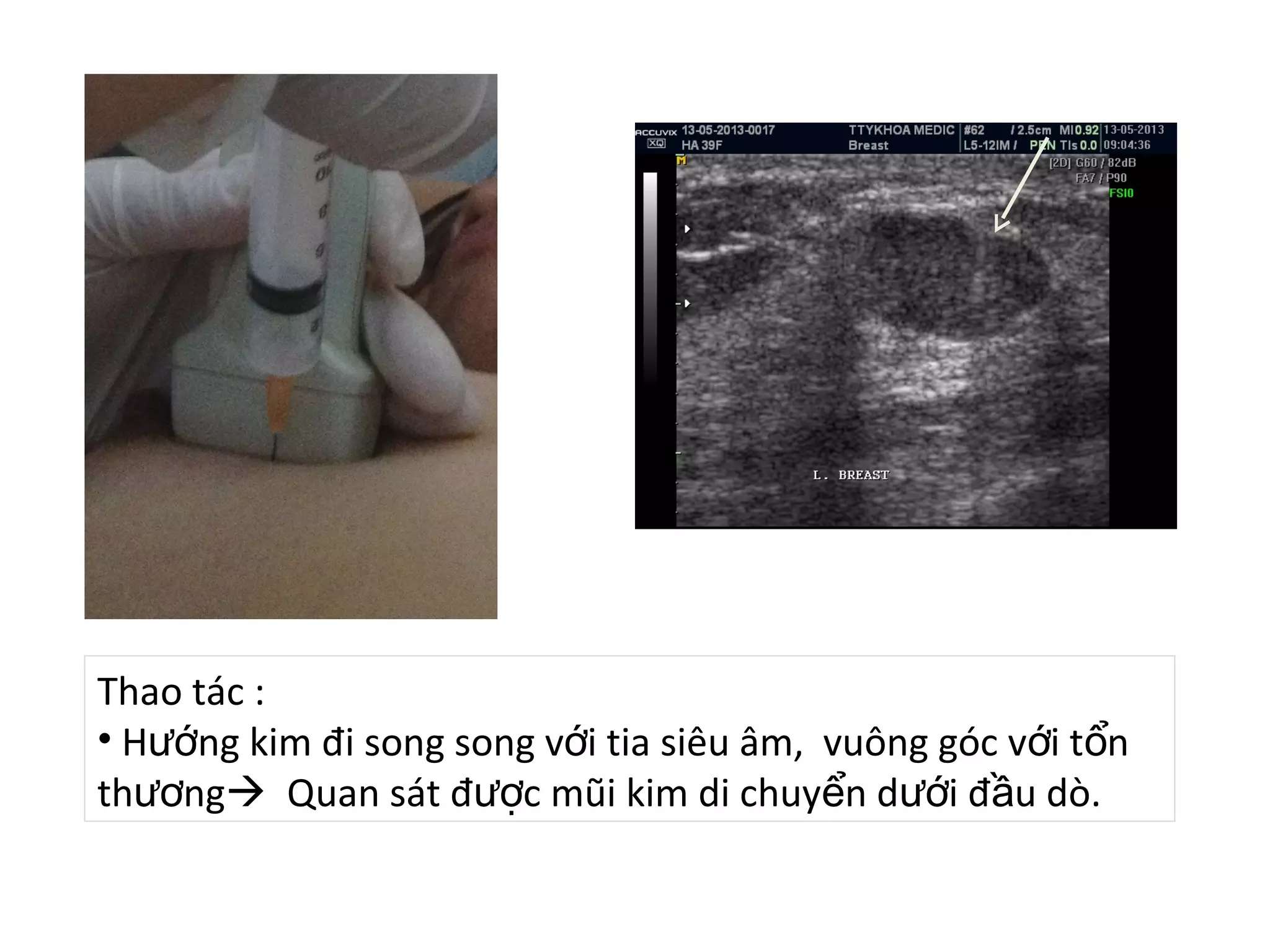 Ultrasound-Guided Breast FNAC | PPT