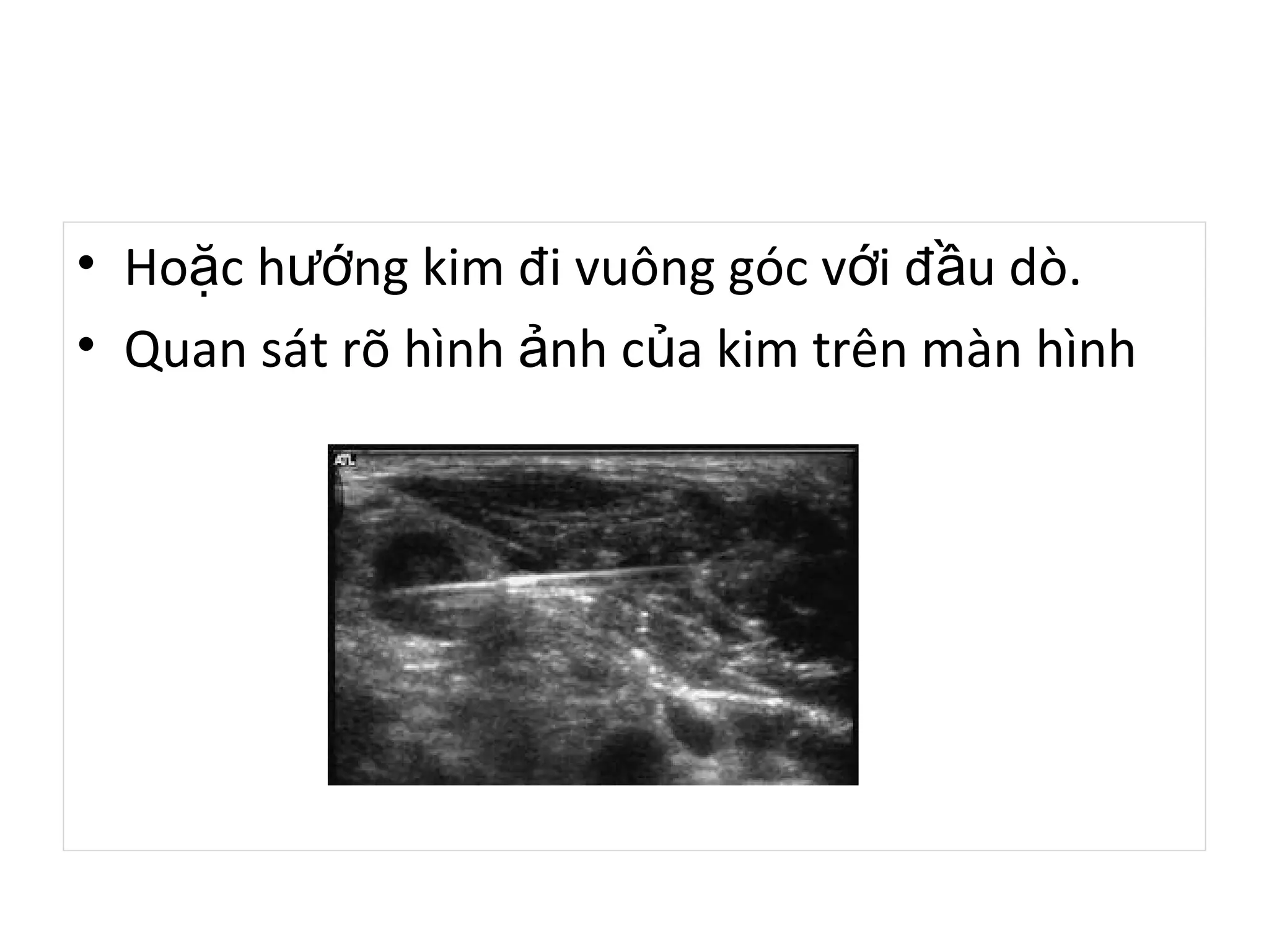 Ultrasound-Guided Breast FNAC | PPT