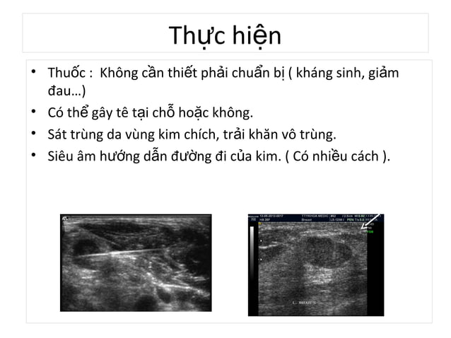Ultrasound-Guided Breast FNAC | PPT