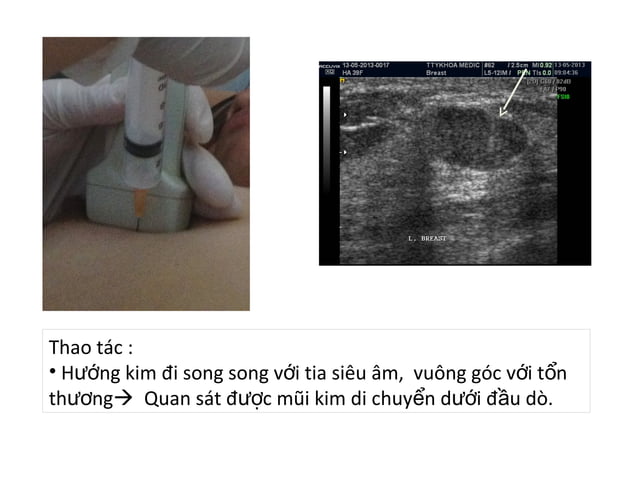 Ultrasound-Guided Breast FNAC | PPT