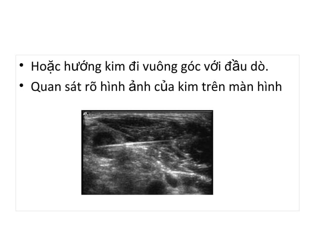 Ultrasound-Guided Breast FNAC | PPT