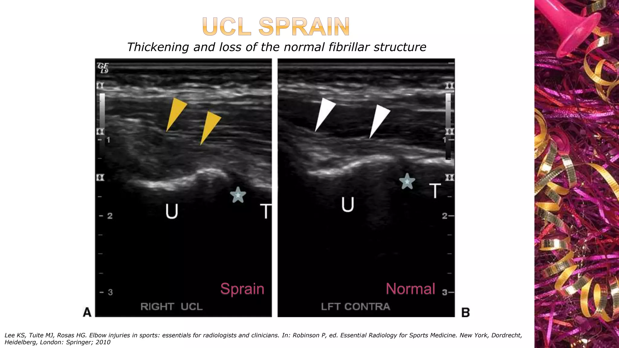 Ultrasound Guided Elbow Injections | PPTX