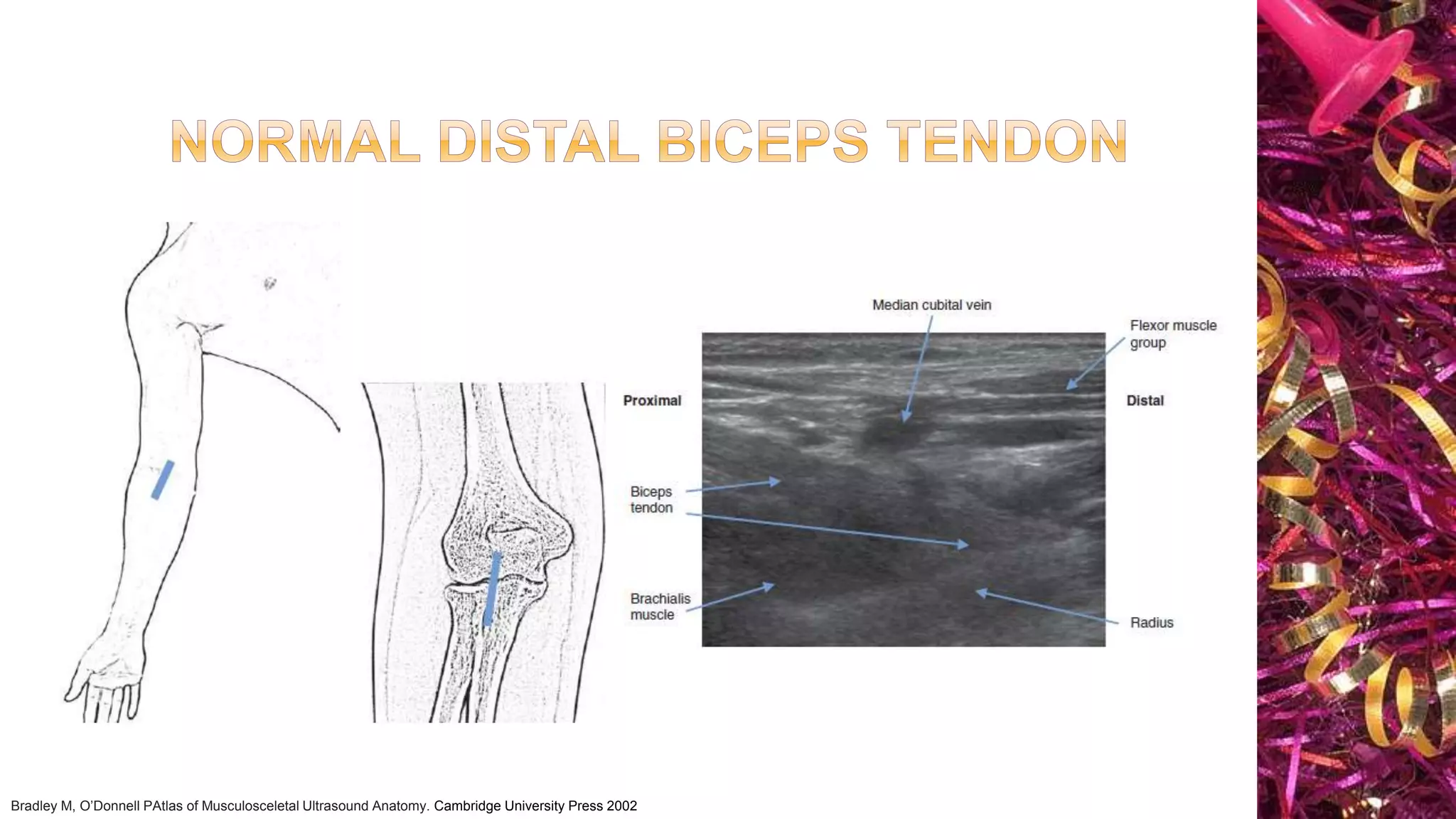 Ultrasound Guided Elbow Injections | PPTX