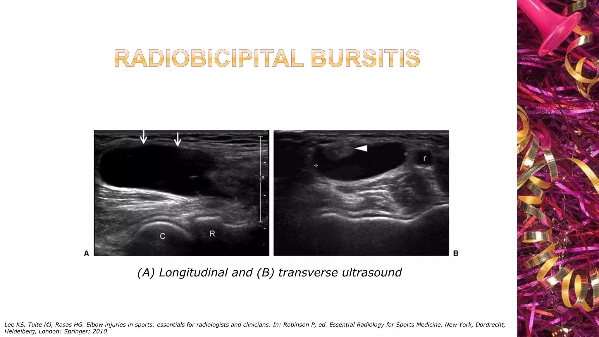 Ultrasound Guided Elbow Injections | PPTX