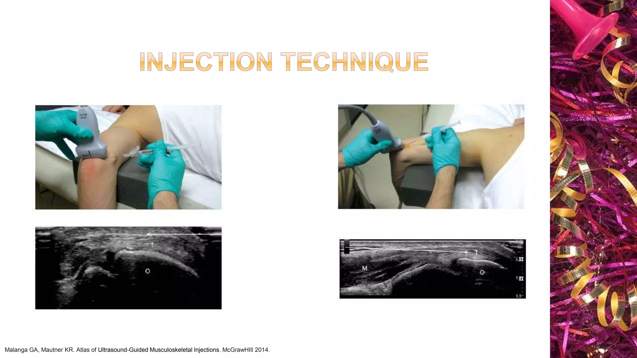 Ultrasound Guided Elbow Injections | PPTX