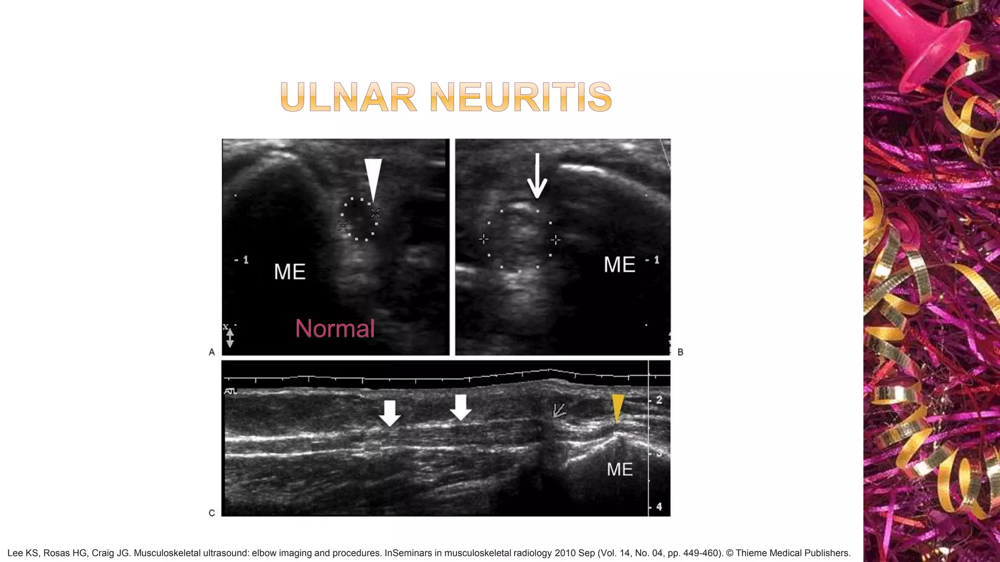 Ultrasound Guided Elbow Injections | PPTX