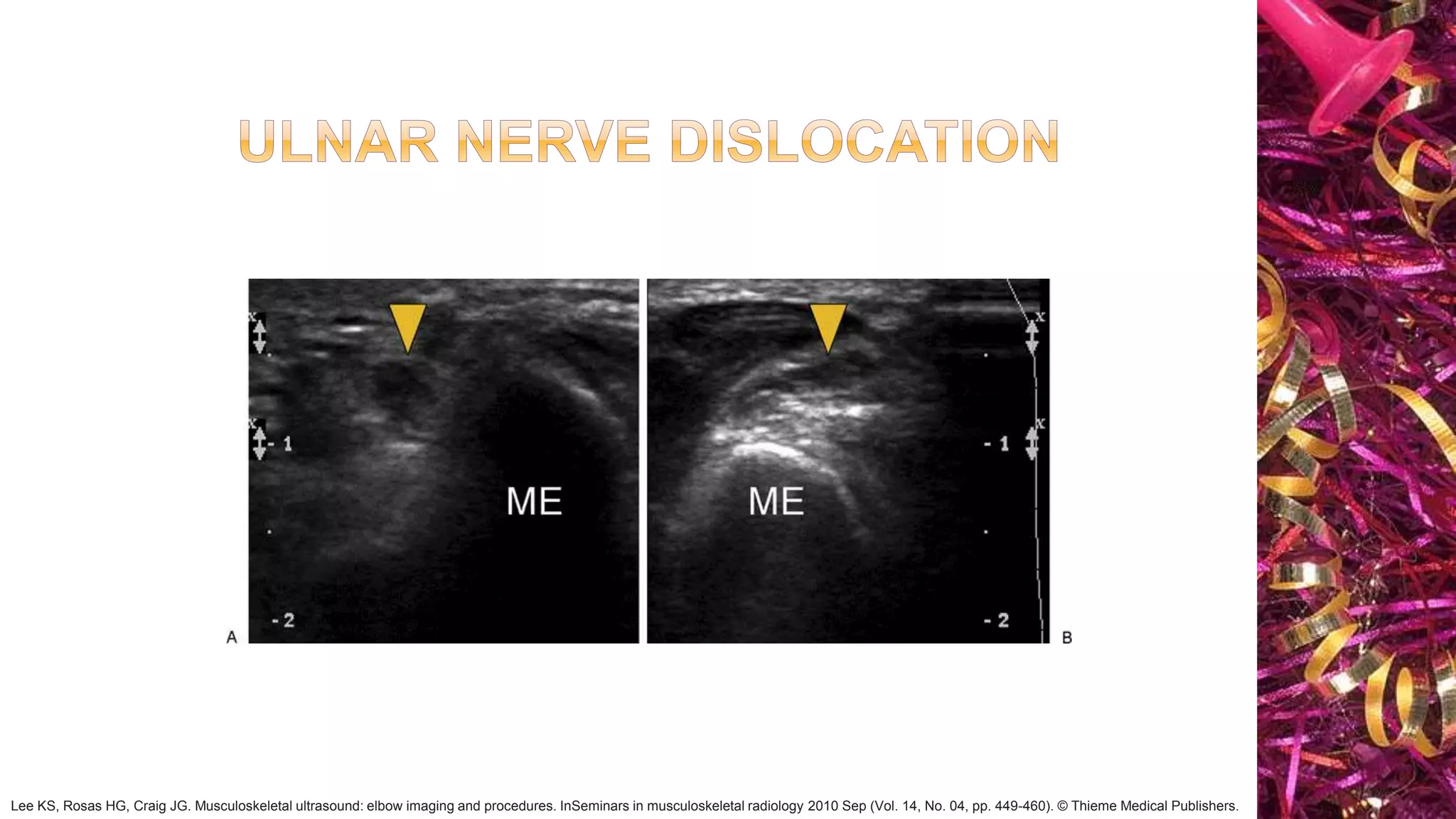 Ultrasound Guided Elbow Injections | PPTX