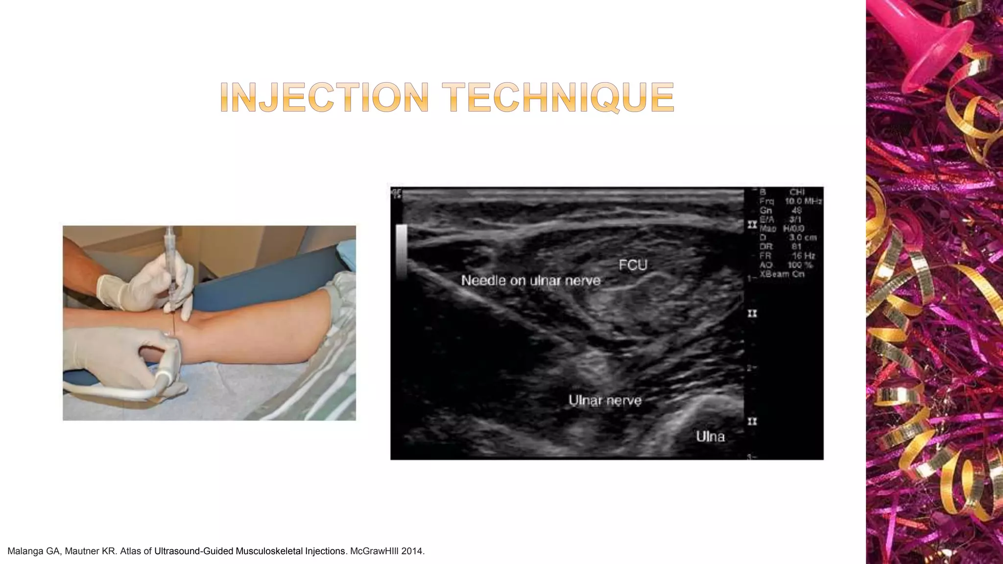 Ultrasound Guided Elbow Injections | PPTX