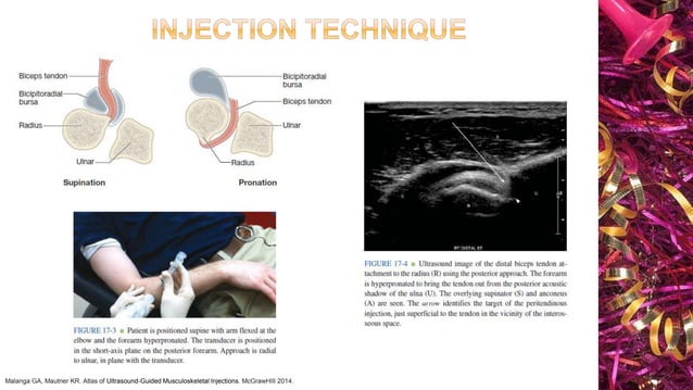 Ultrasound Guided Elbow Injections | PPTX | Death, Injury, or Military ...