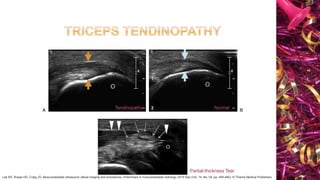 Ultrasound Guided Elbow Injections | PPTX