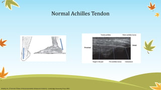 Ultrasound Guided Foot and Ankle Injections | PPTX