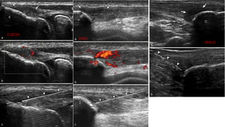 Ultrasound-Guided Percutaneous Tenotomy | PPTX