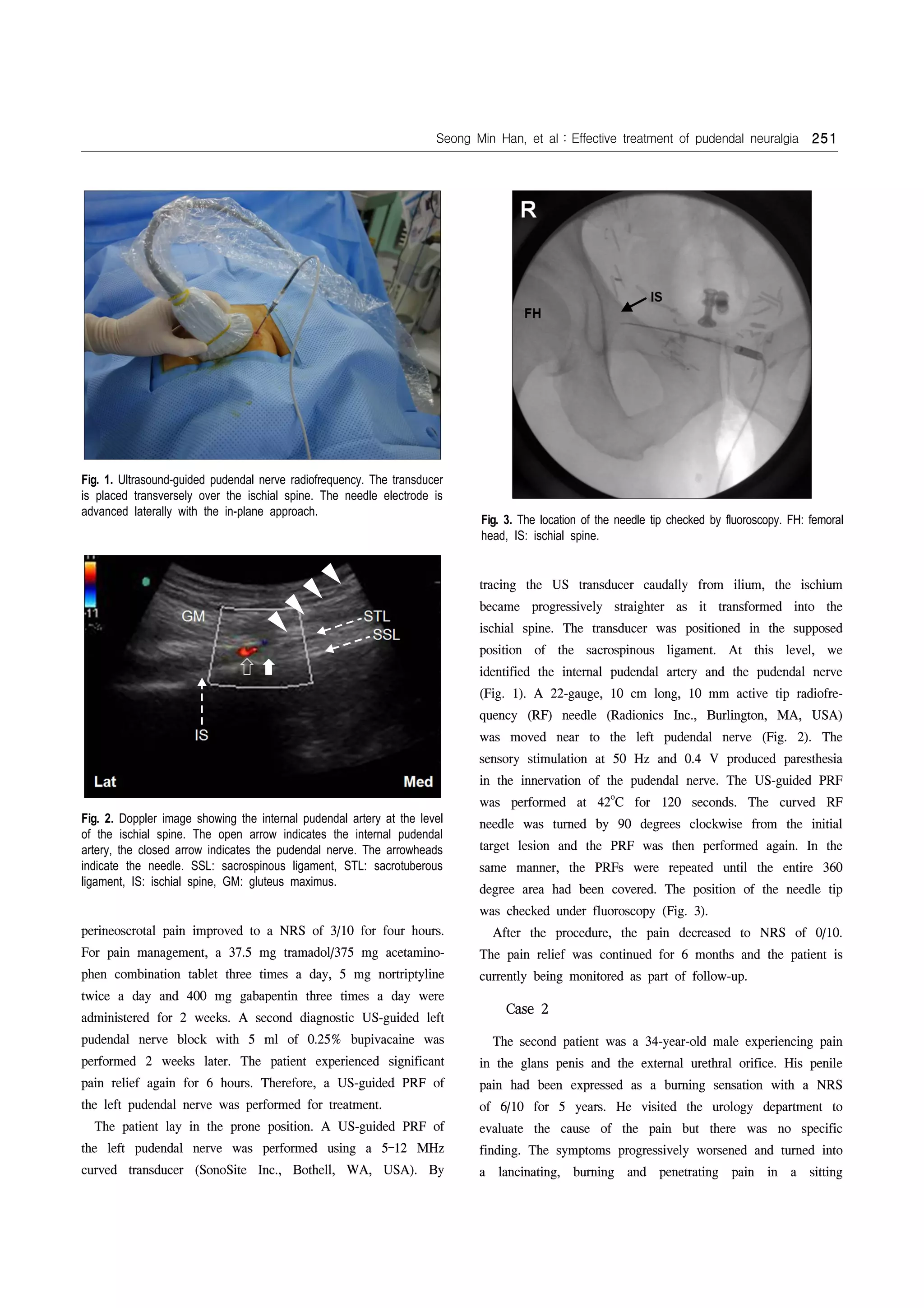 Ultrasound guided pudendal nerve pulsed radiofrequency in patients with refractory pudendal ...