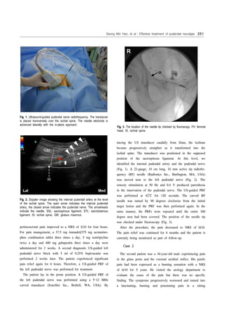Ultrasound guided pudendal nerve pulsed radiofrequency in patients with refractory pudendal ...