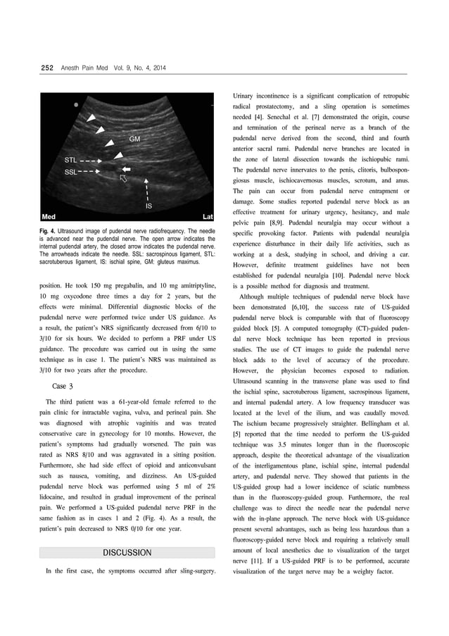 Ultrasound guided pudendal nerve pulsed radiofrequency in patients with refractory pudendal ...