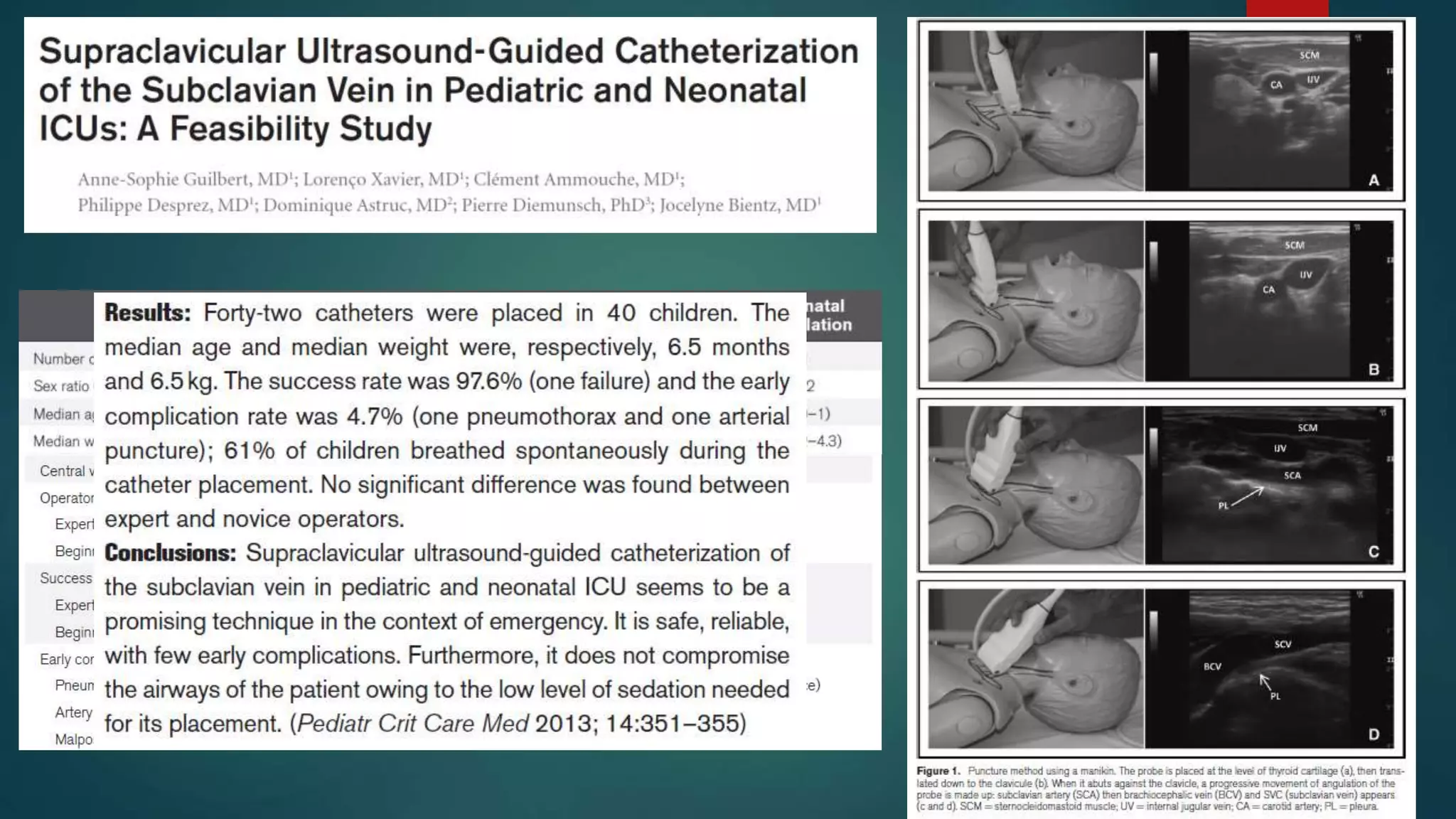 Ultrasound guided subclavian vein catheterization in pediatric patients ...